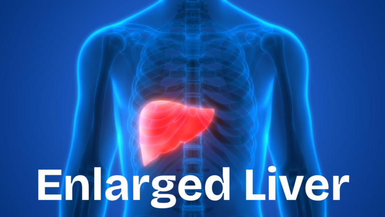 Enlarged Liver - Maruthuva Valam