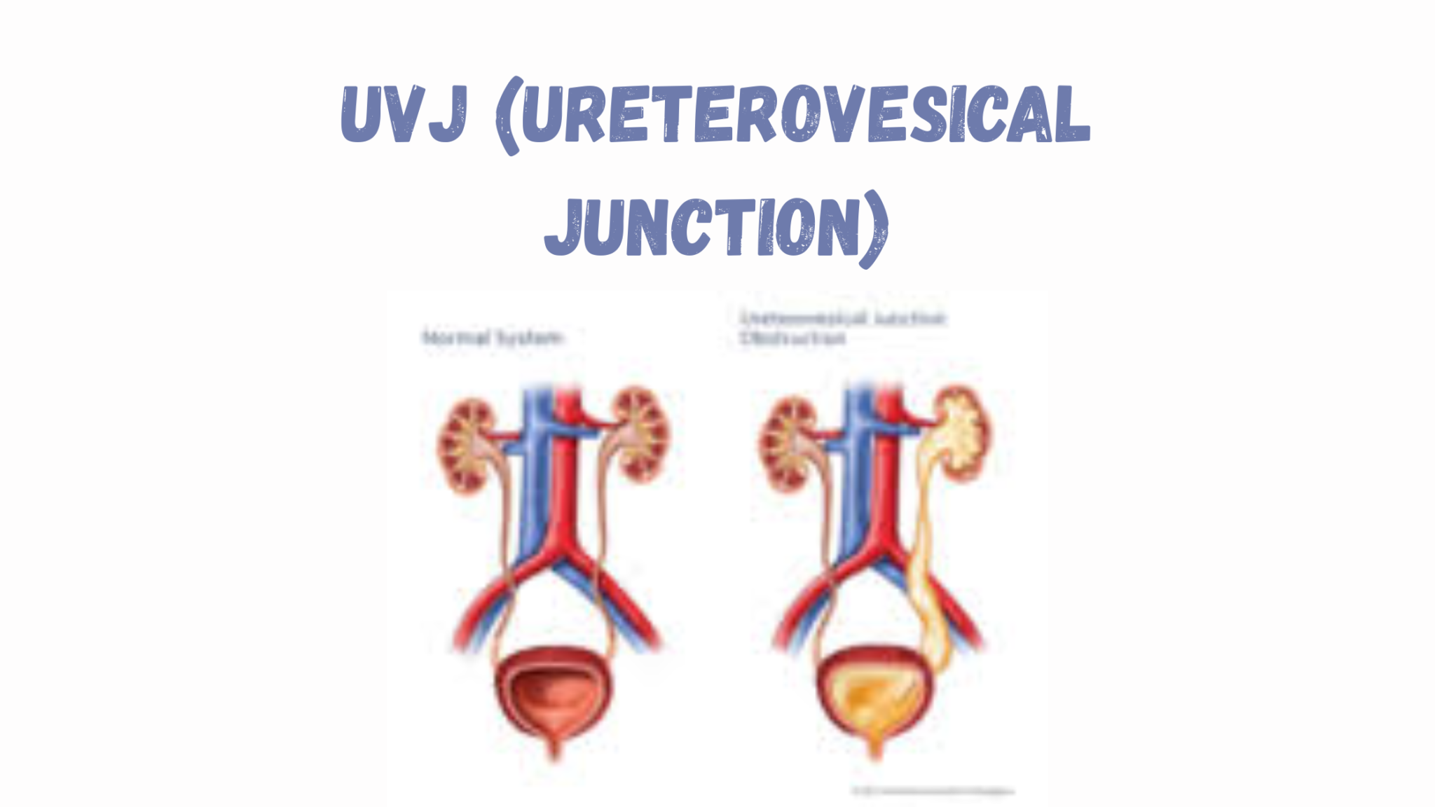 UVJ (Ureterovesical Junction) - Maruthuva Valam